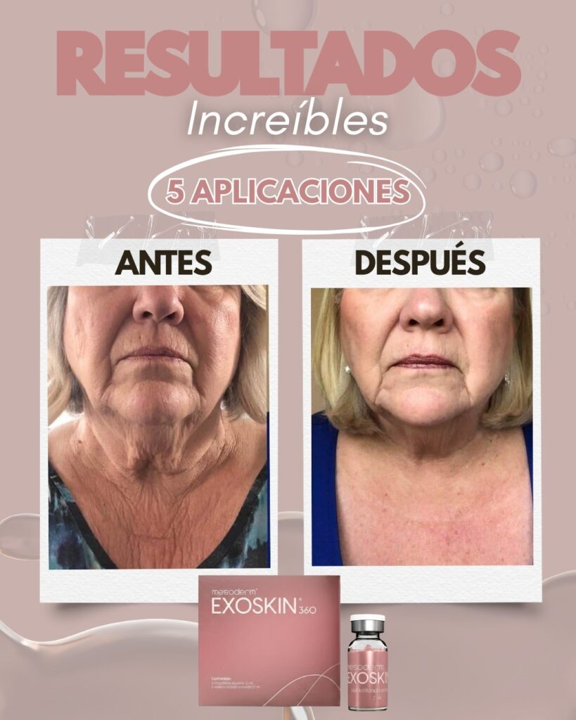 EXOSKIN 360 1 Caja - Meso10 México