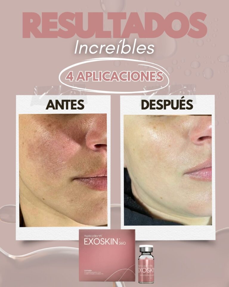 EXOSKIN 360 3 Cajas - Meso10 México